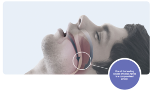 How does the Vivos treatment work? - Dr. Rebecca Havel DDS, SC